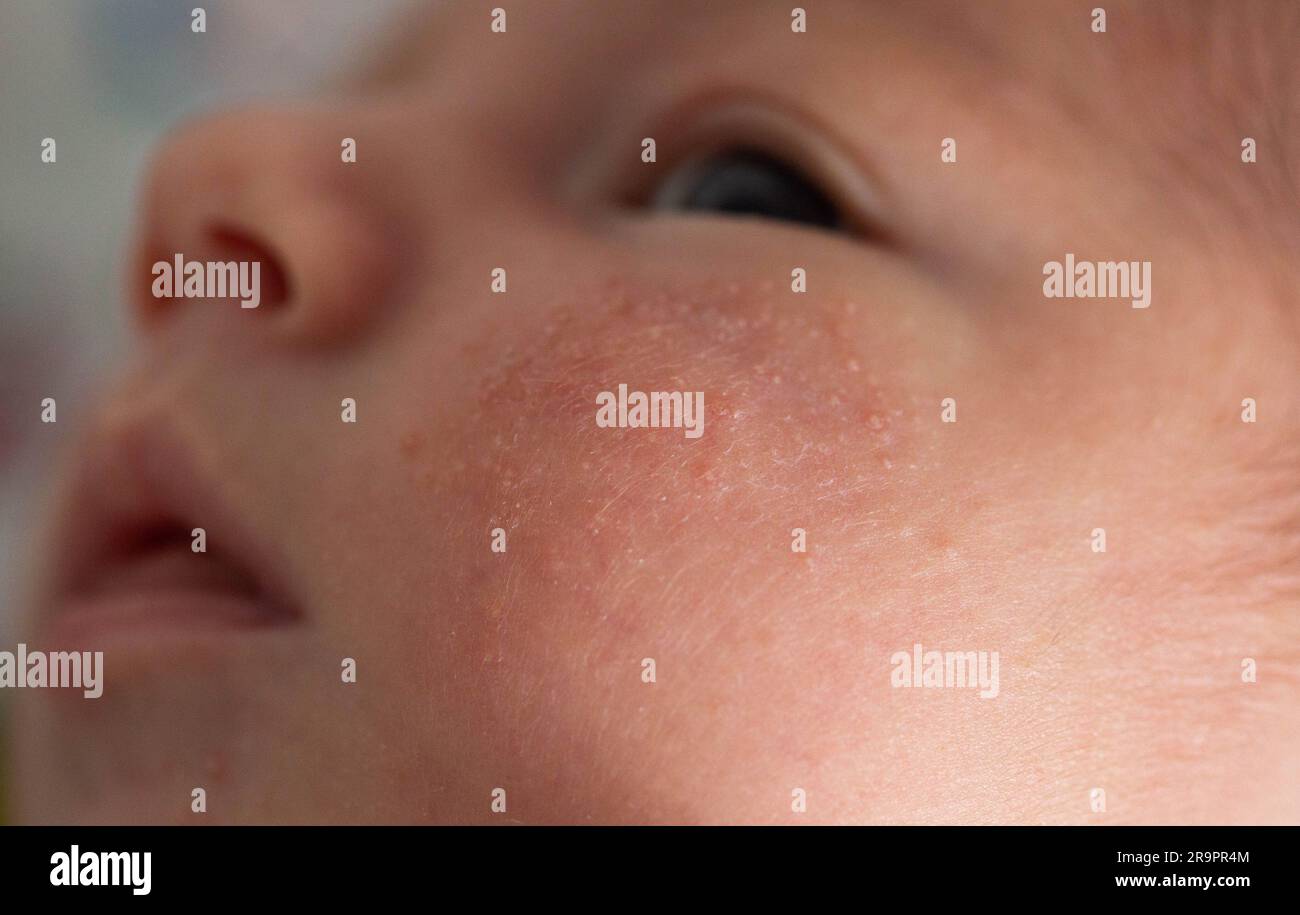 Rash on the face of a newborn baby. The process of formation of the ...