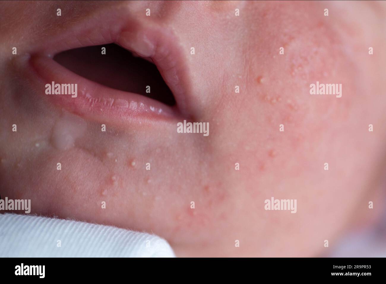 Pimples on the face of a newborn. Baby's adaptation to the environment ...