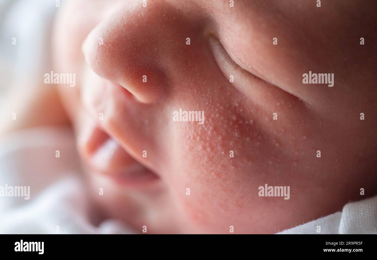 Pimples on the face of a newborn. Baby's adaptation to the environment ...