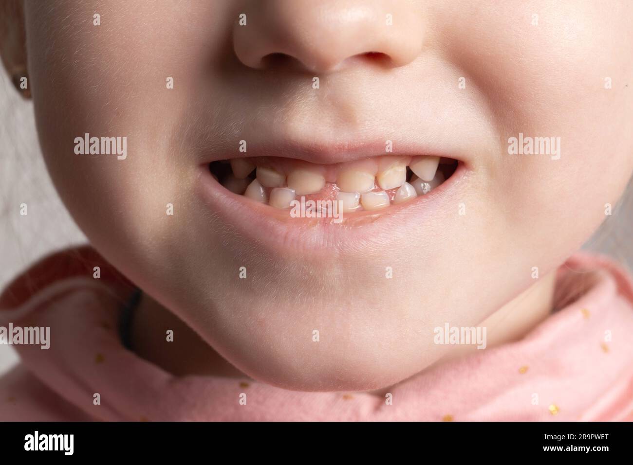 Beautiful smile of a child without one tooth. Change of milk teeth ...