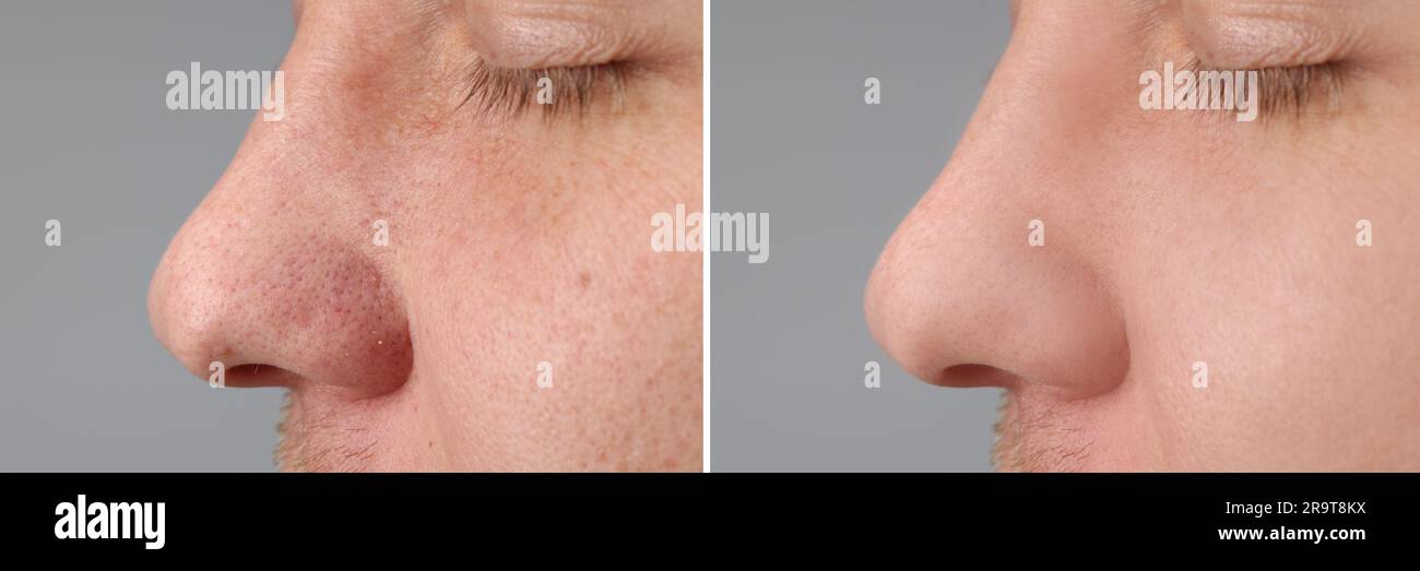 Before and after acne treatment. Photos of man on grey background ...