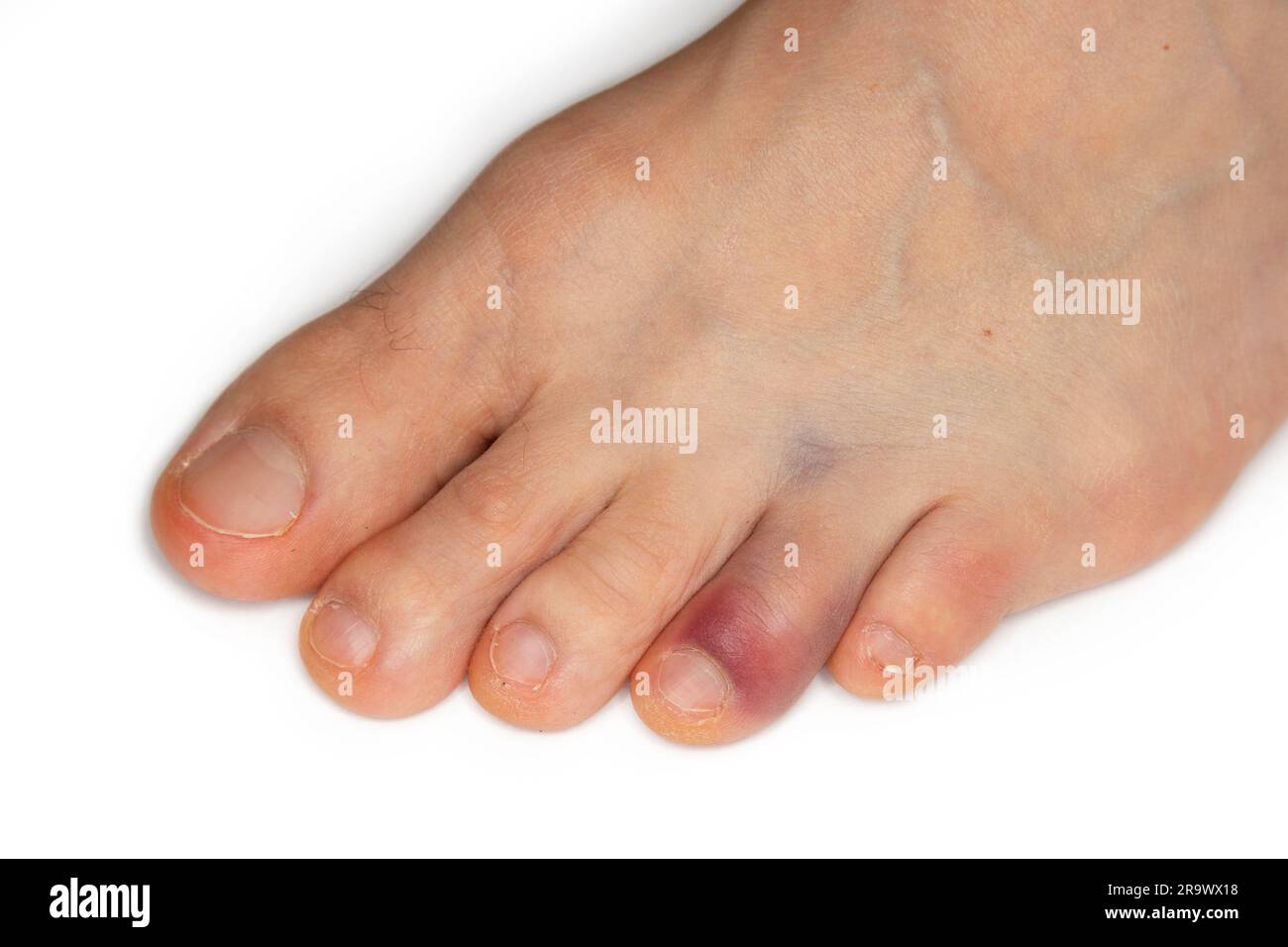 Close up of a broken toe - a common injury that's most often caused by ...