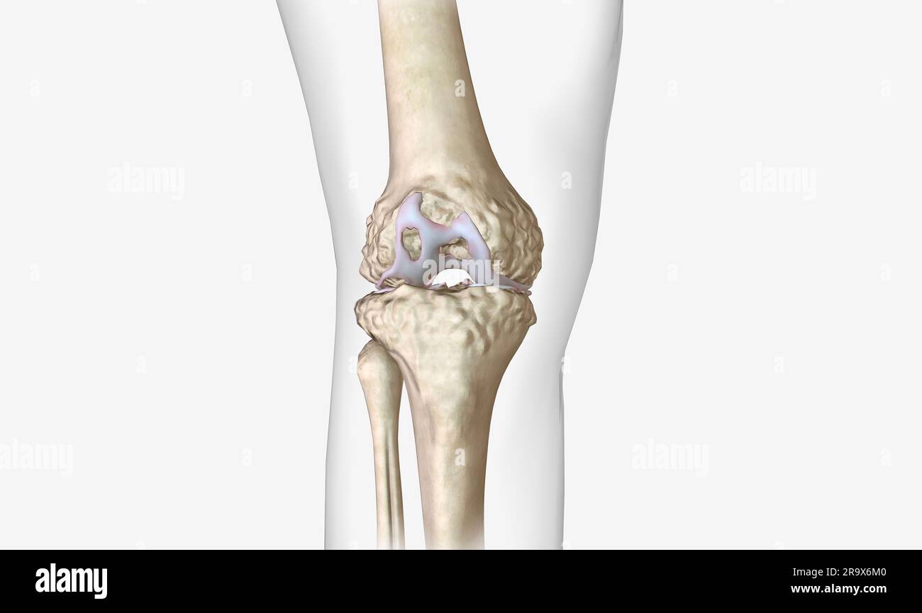 Knee osteoarthritis 3d scan hi-res stock photography and images - Alamy