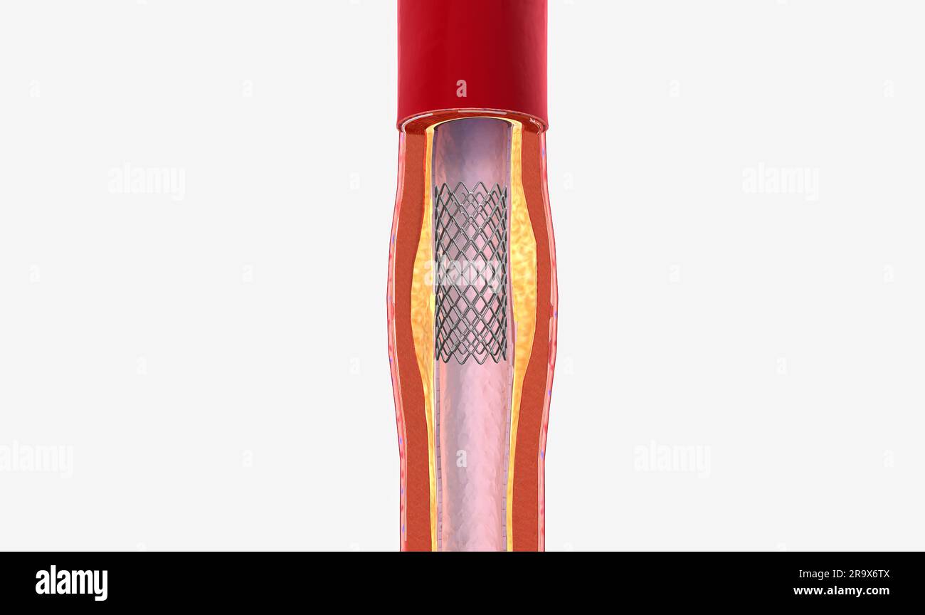 The balloon expends, widening the wire mesh stent and the artery 3D ...