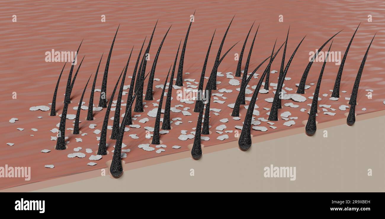 Hair follicles and dandruff under microscope - 3D illustration Stock ...