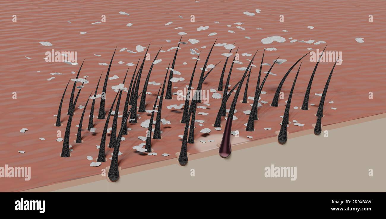 Hair follicles and dandruff under microscope - 3D illustration Stock ...