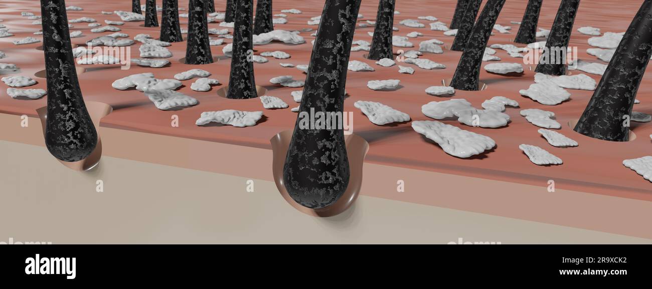 Hair follicles and dandruff under microscope - 3D illustration Stock ...