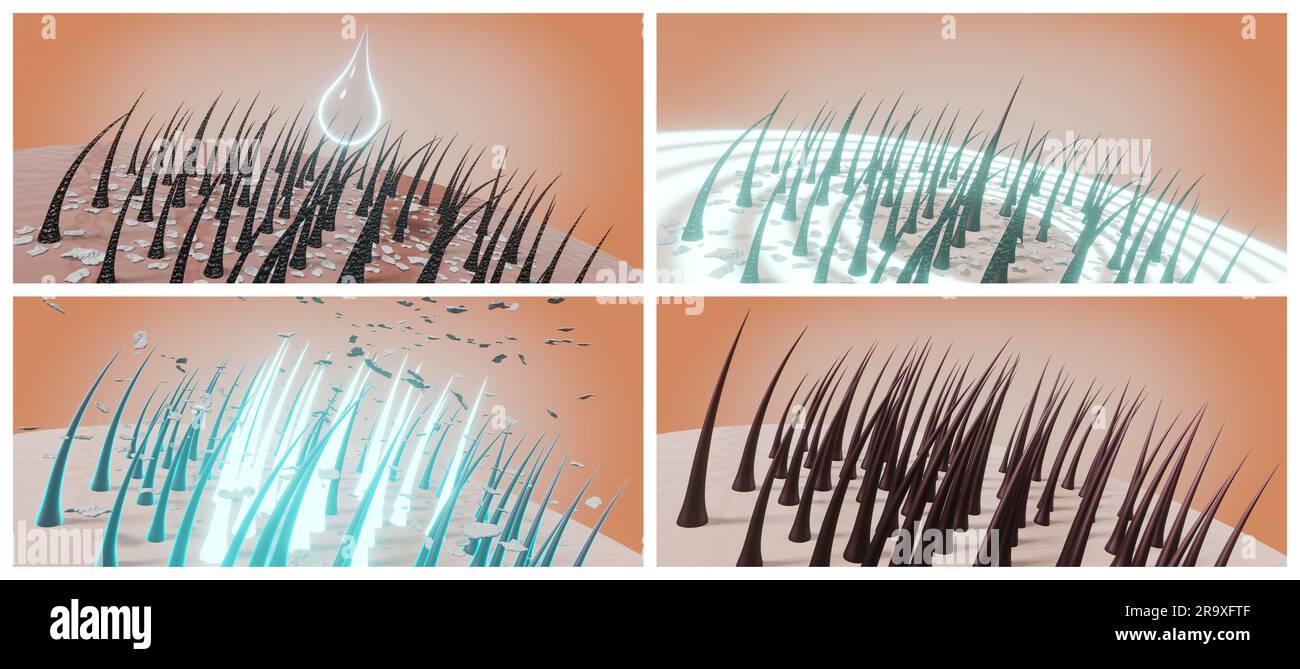 Hair follicles and dandruff - steps in therapy - 3D illustration Stock ...