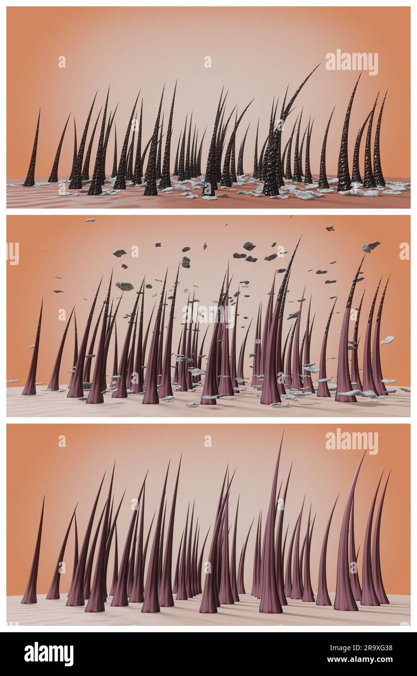 Hair follicles and dandruff - steps in therapy - 3D illustration Stock ...