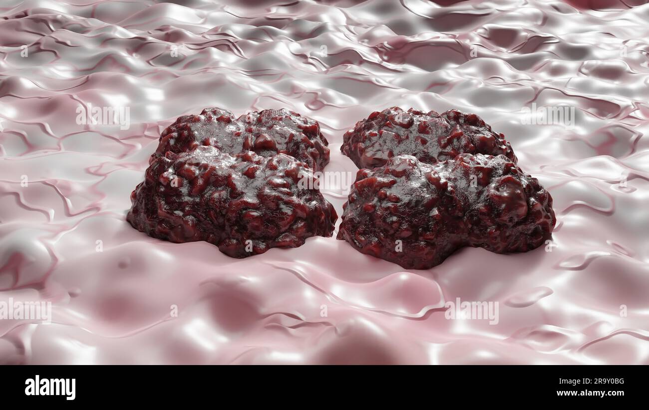 Cancer cell growth uncontrollably over tissue, Tumor infection cells ...