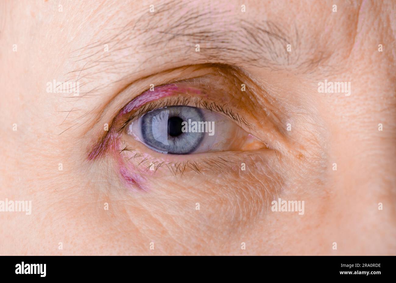 Woman's eye injured due to rupture of capillary, causing hematoma or ...