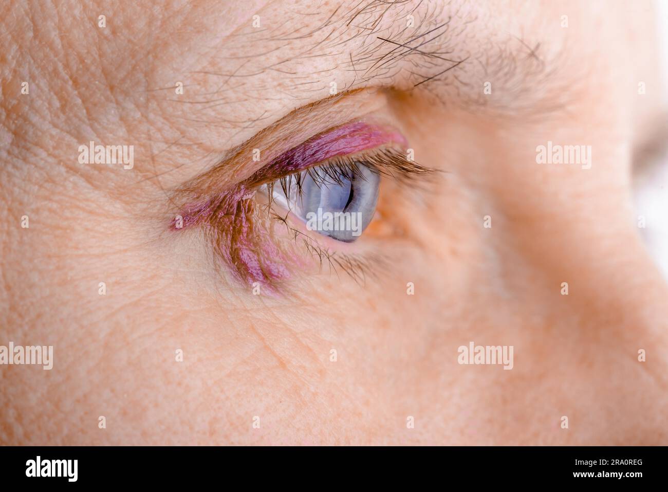 Woman's eye injured due to rupture of capillary, causing hematoma or ...
