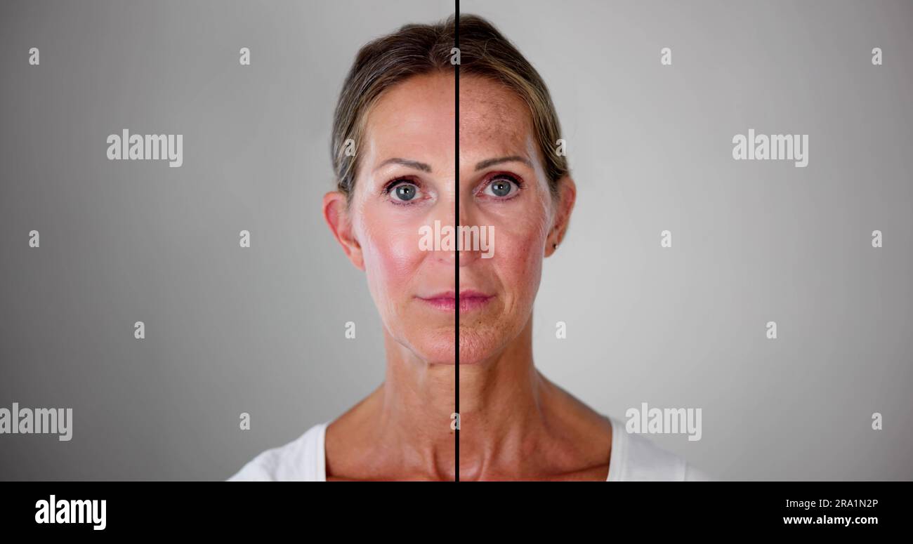 Woman Before And After Face Lift Therapy Injection Stock Photo - Alamy