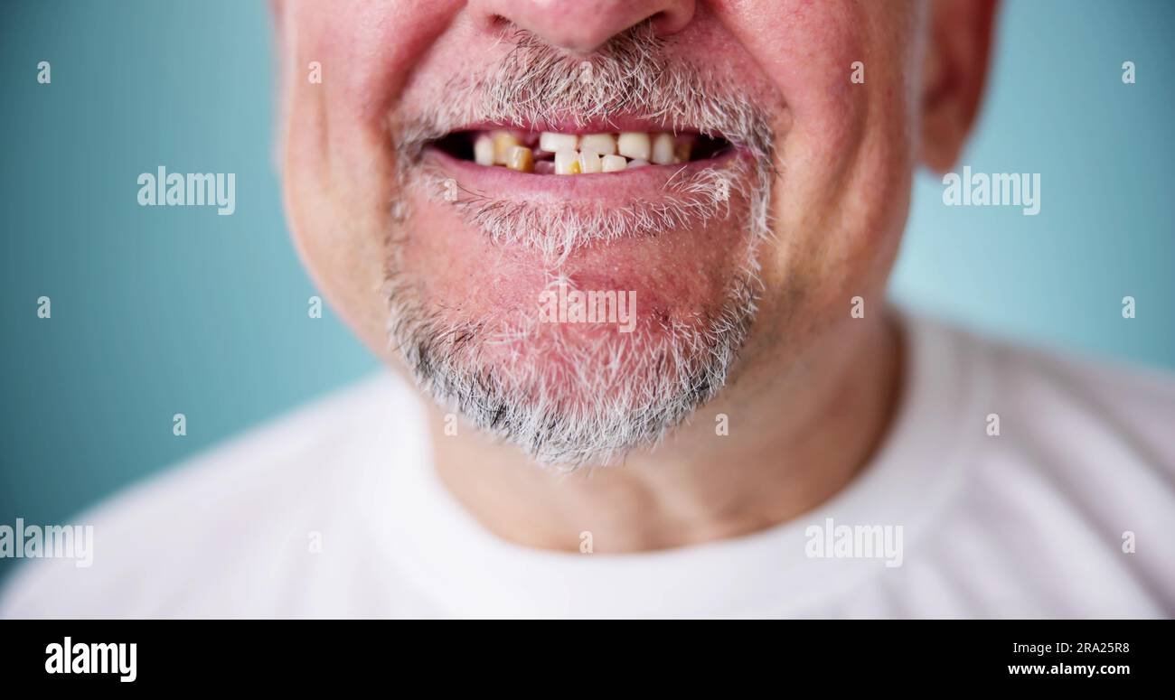 Smile With Missing Tooth. Broken Tooth Absence Stock Photo - Alamy