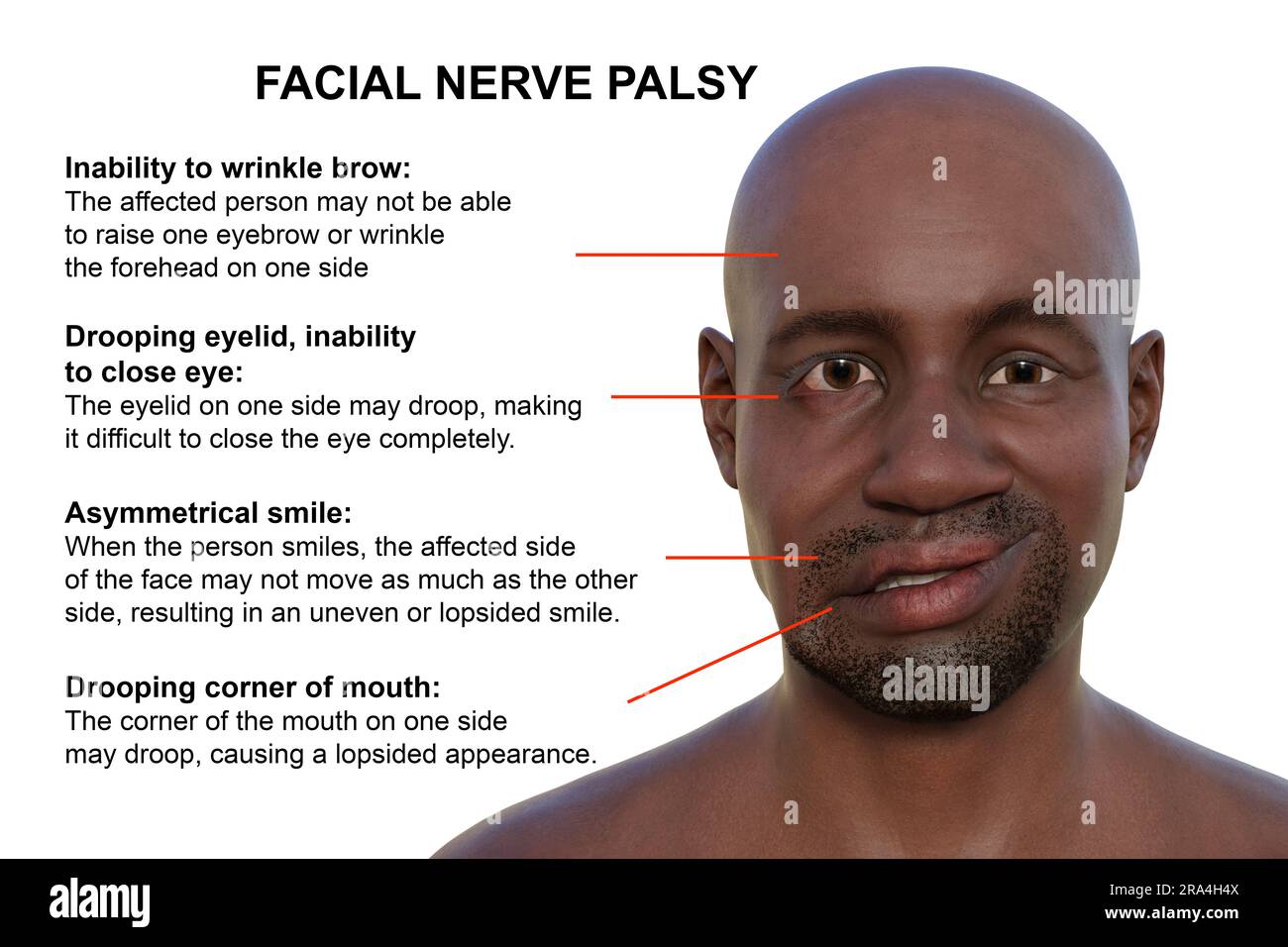 Facial palsy, illustration Stock Photo - Alamy
