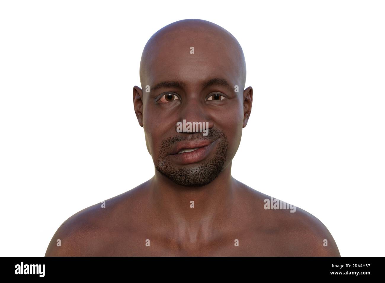 Bell's palsy hi-res stock photography and images - Alamy