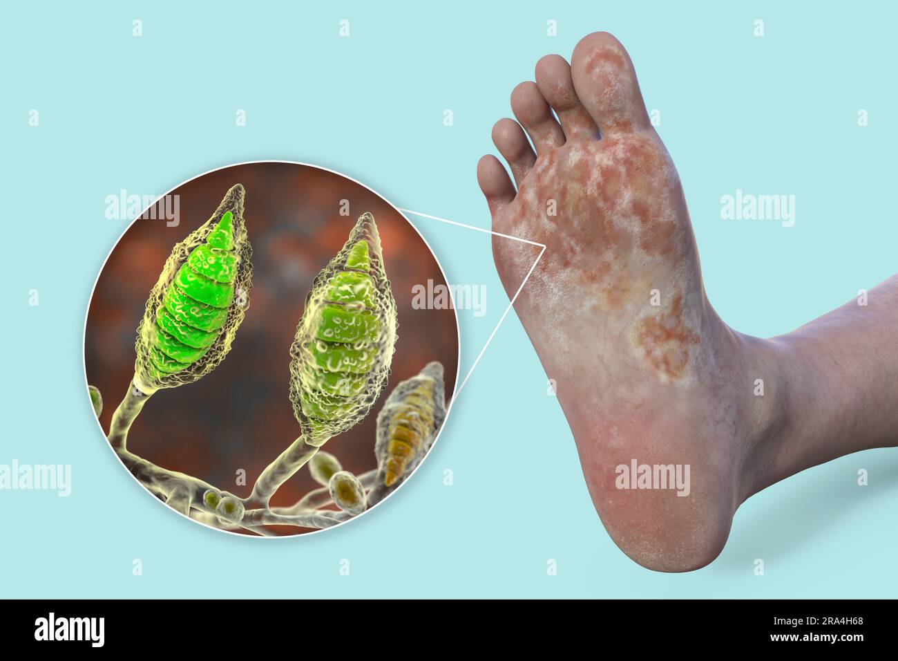 Microsporum canis infection of the foot, illustration Stock Photo - Alamy