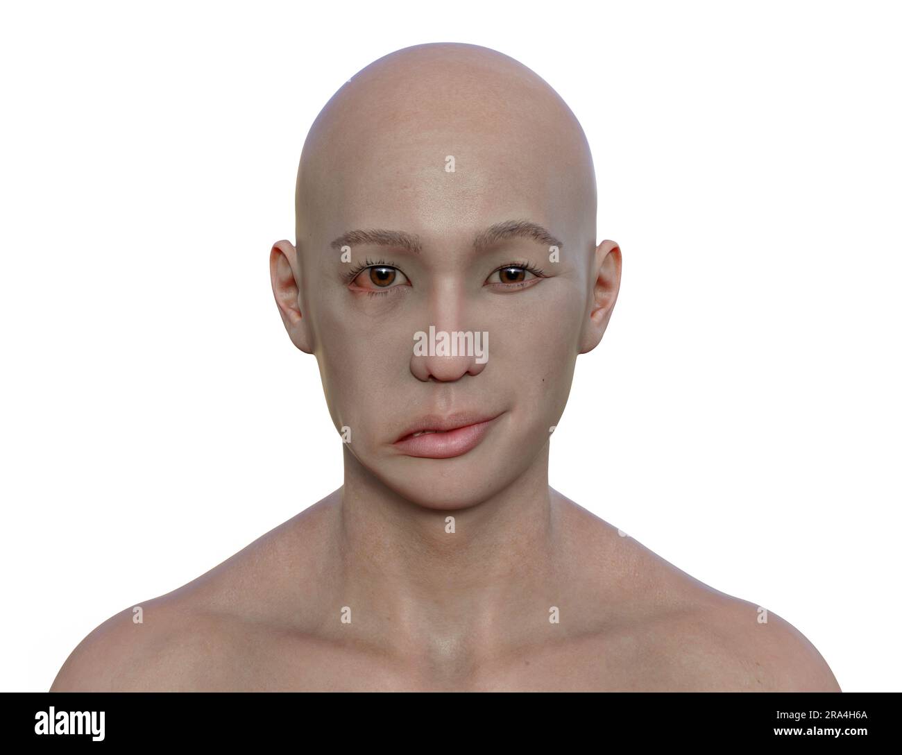 Facial palsy, illustration Stock Photo - Alamy