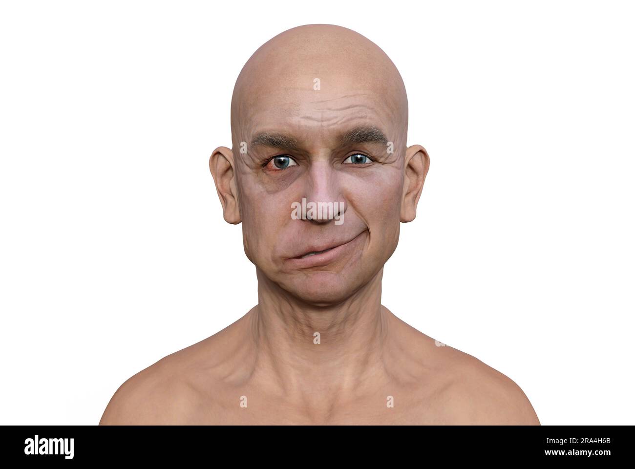 Facial palsy, illustration Stock Photo - Alamy