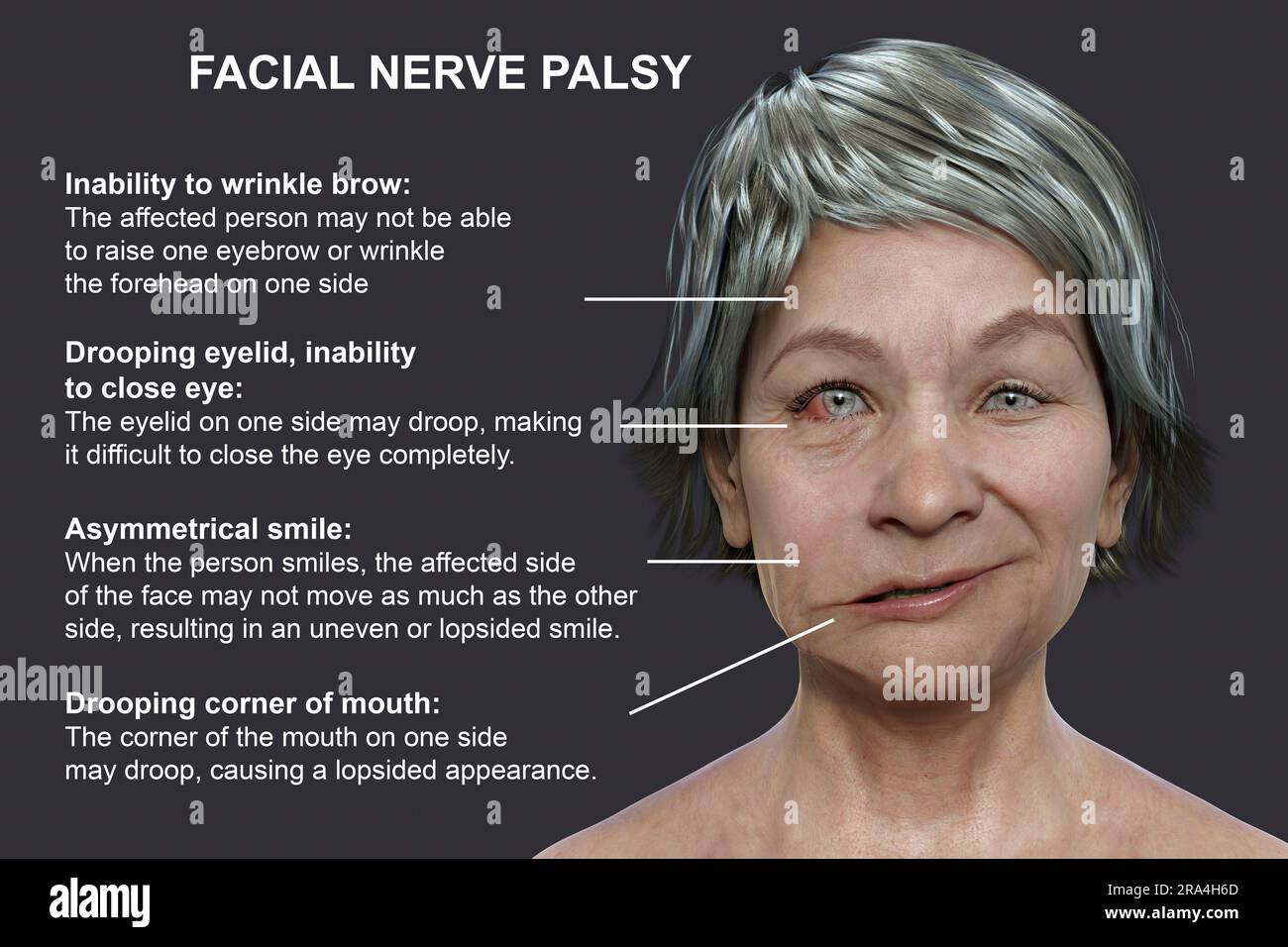 Facial palsy, illustration Stock Photo - Alamy