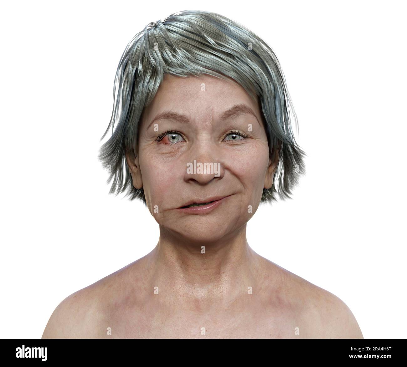 Facial palsy, illustration Stock Photo - Alamy