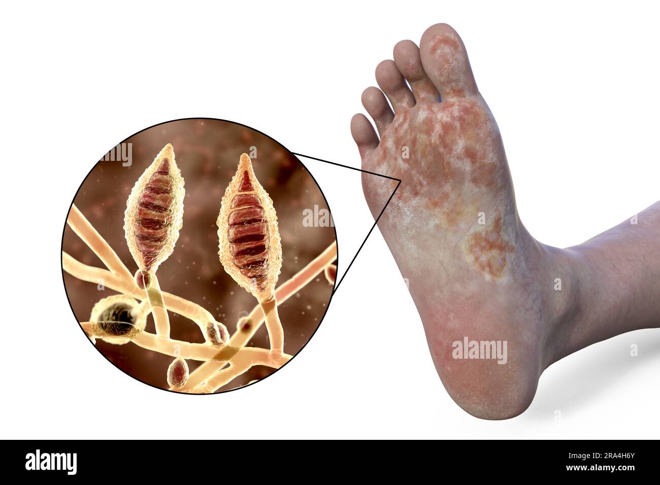 Microsporum canis infection of the foot, illustration Stock Photo - Alamy
