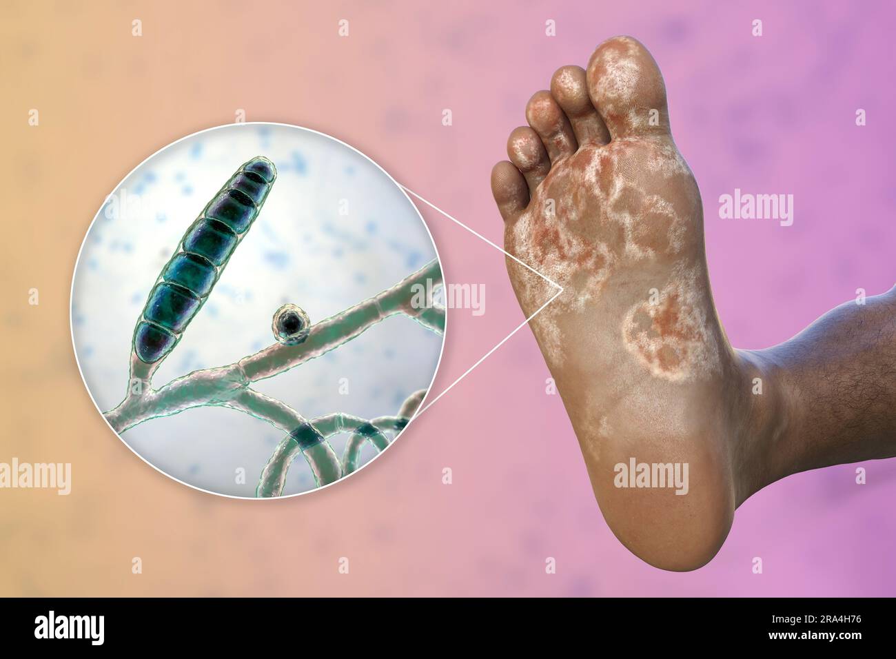 Athletes Foot Under Microscope