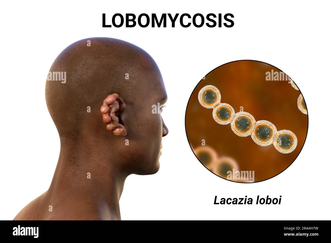 Lobomycosis fungal infection, illustration Stock Photo - Alamy