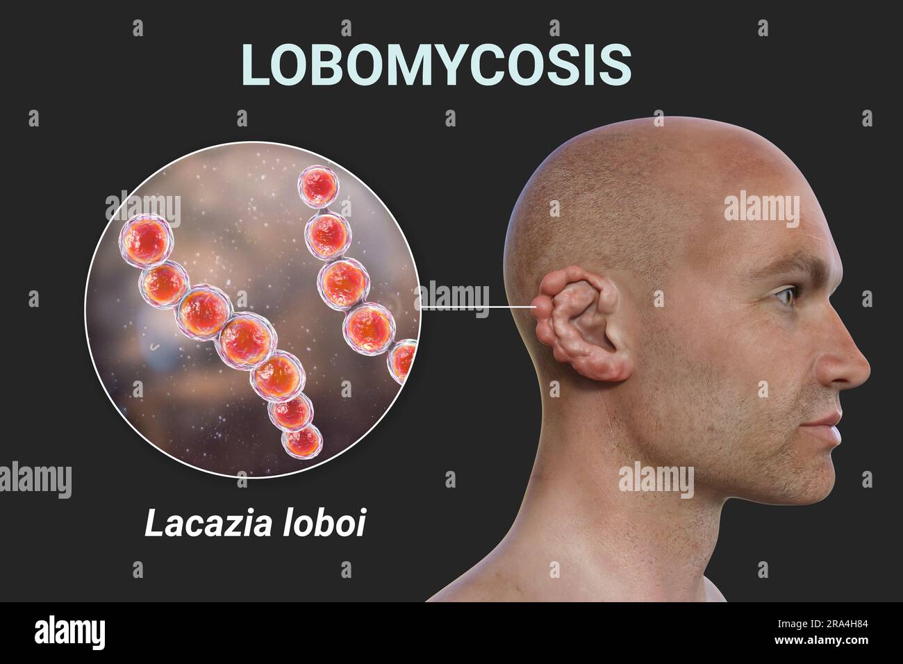 Lobomycosis fungal infection, illustration Stock Photo - Alamy