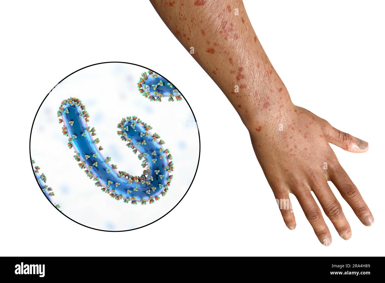 Rash in Marburg haemorrhagic fever, illustration Stock Photo - Alamy