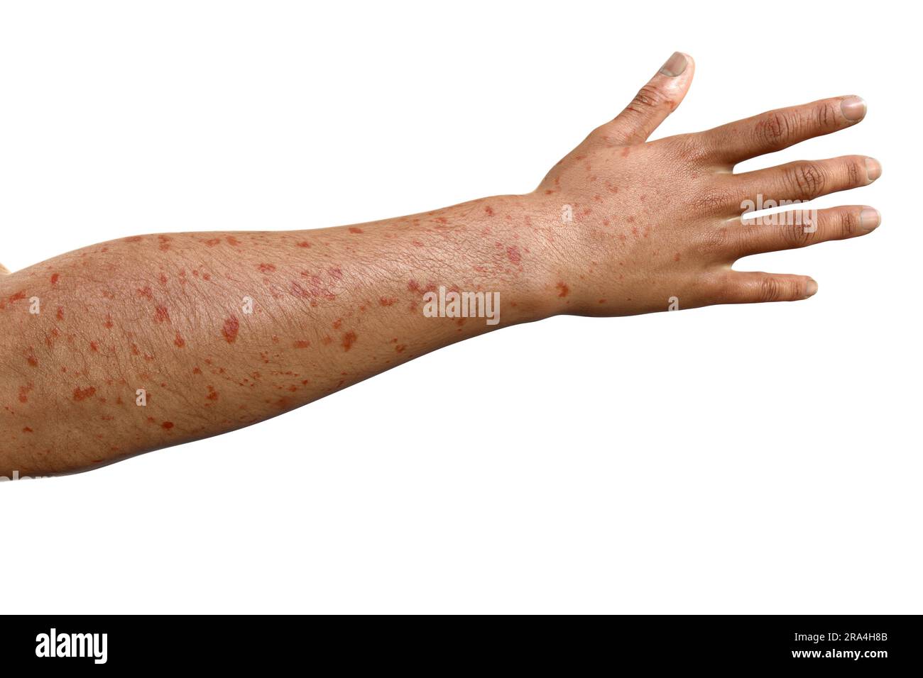 Rash in Marburg haemorrhagic fever, illustration Stock Photo - Alamy