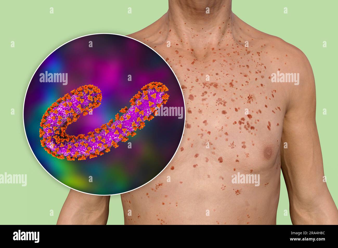 Hemorrhagic rash hi-res stock photography and images - Alamy