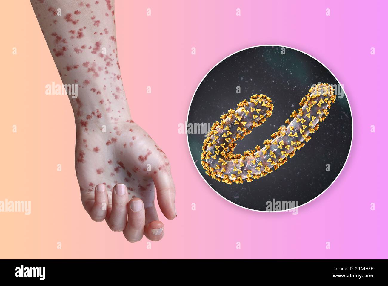 Hemorrhagic rash hi-res stock photography and images - Alamy