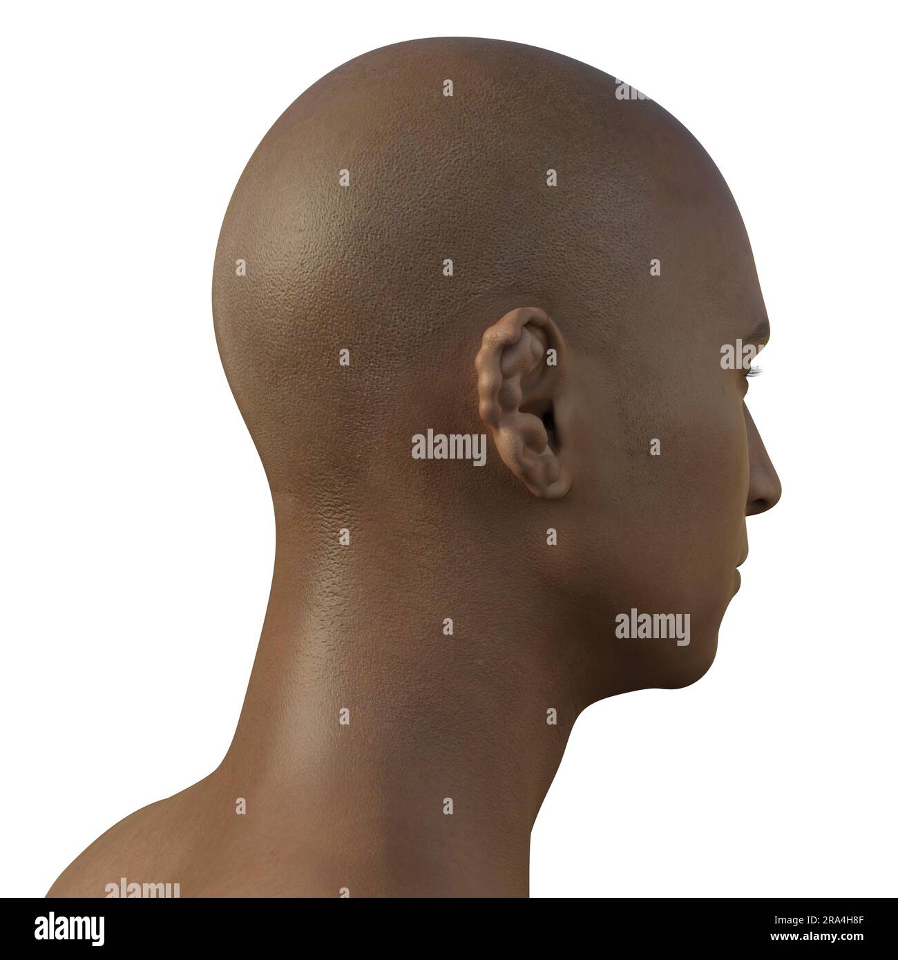 Skin nodules hi-res stock photography and images - Alamy