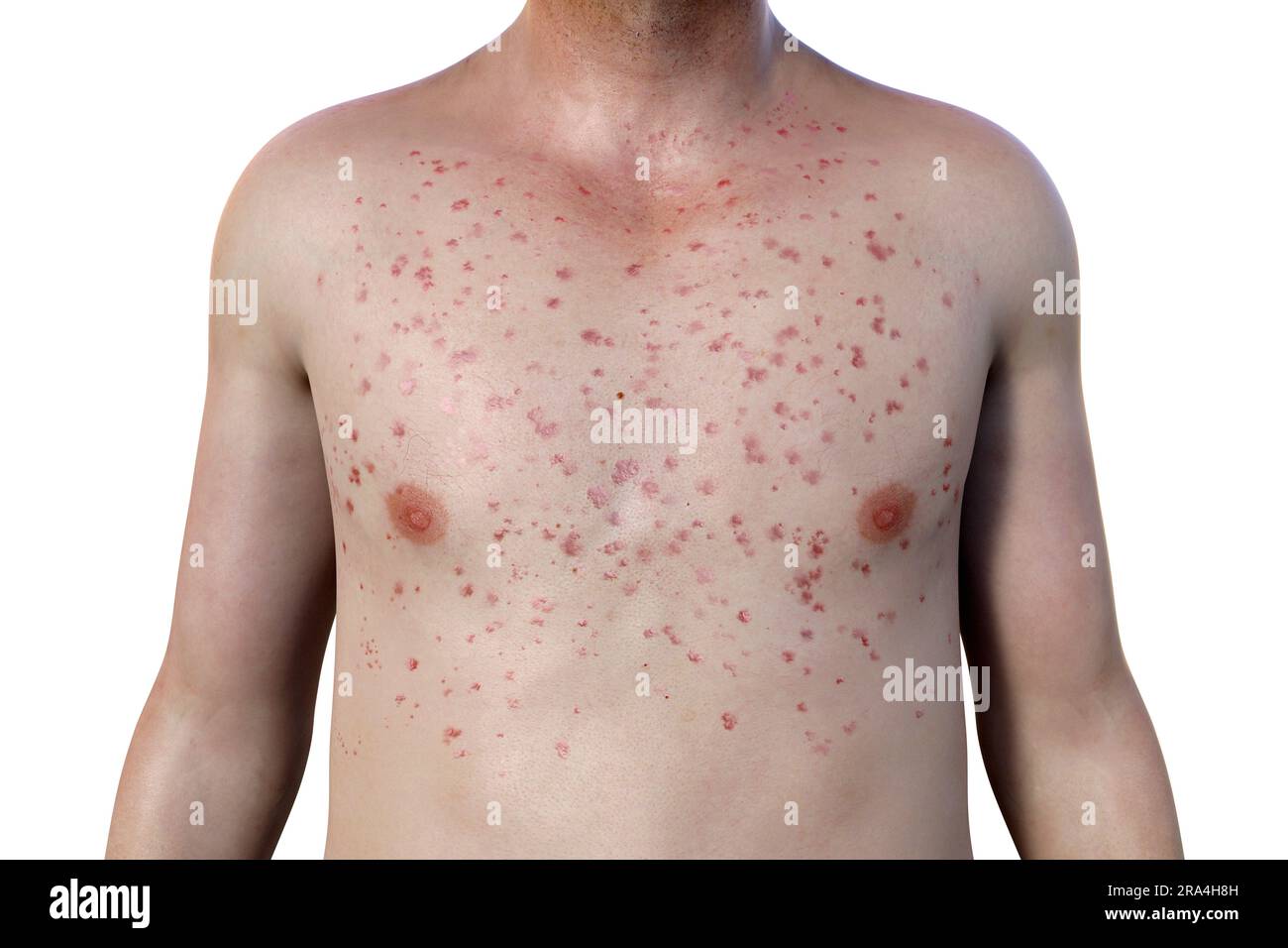 Rash in Marburg haemorrhagic fever, illustration Stock Photo - Alamy