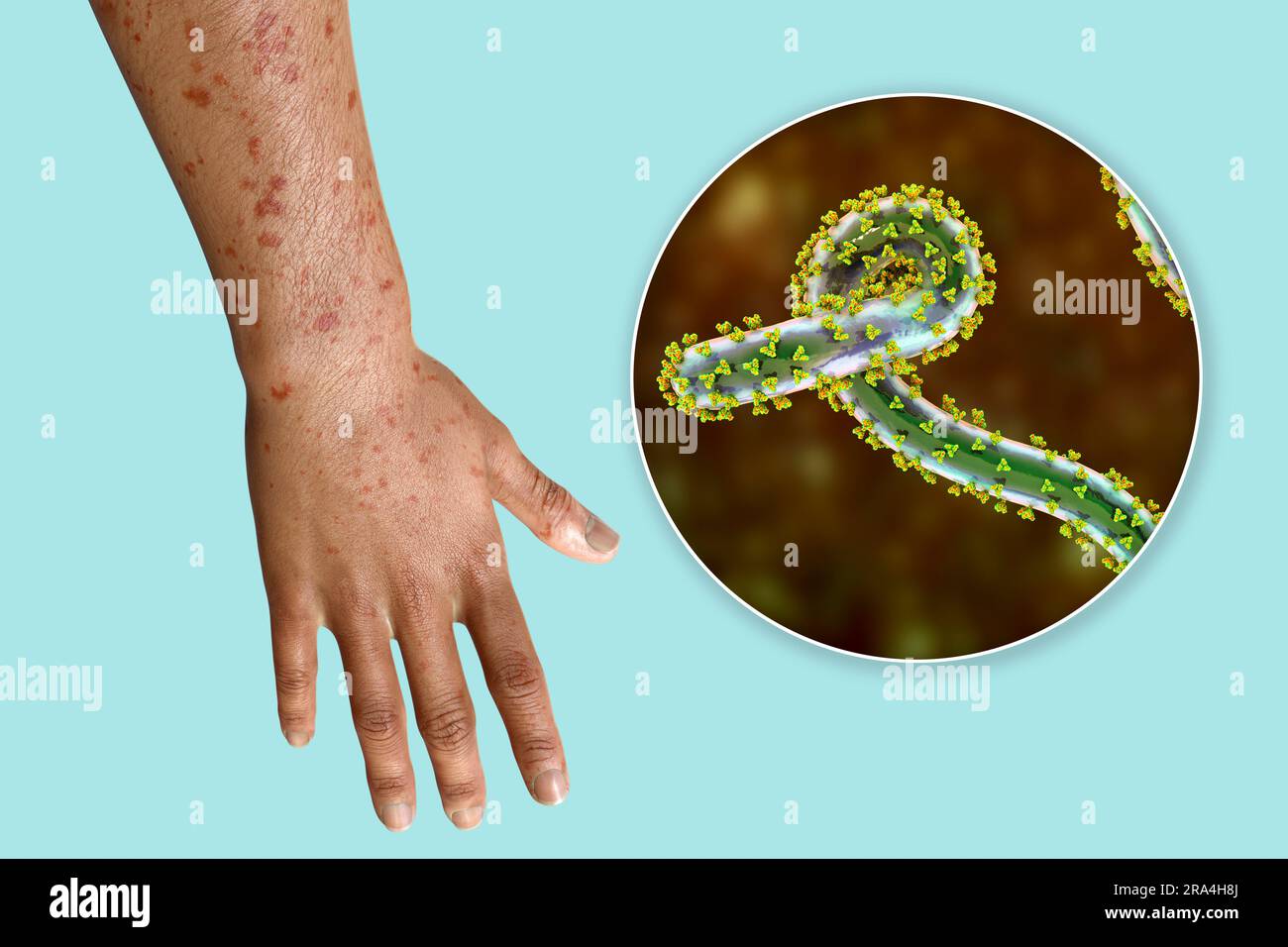 Rash in Marburg haemorrhagic fever, illustration Stock Photo - Alamy