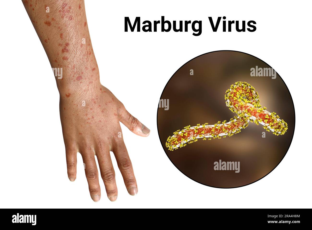 Rash in Marburg haemorrhagic fever, illustration Stock Photo - Alamy