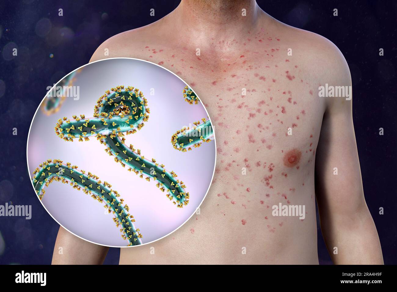 Rash in Marburg haemorrhagic fever, illustration Stock Photo - Alamy