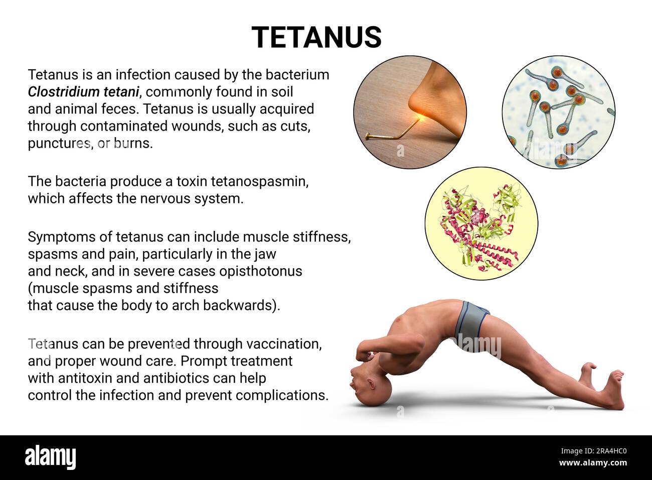 Tetanus Treatment