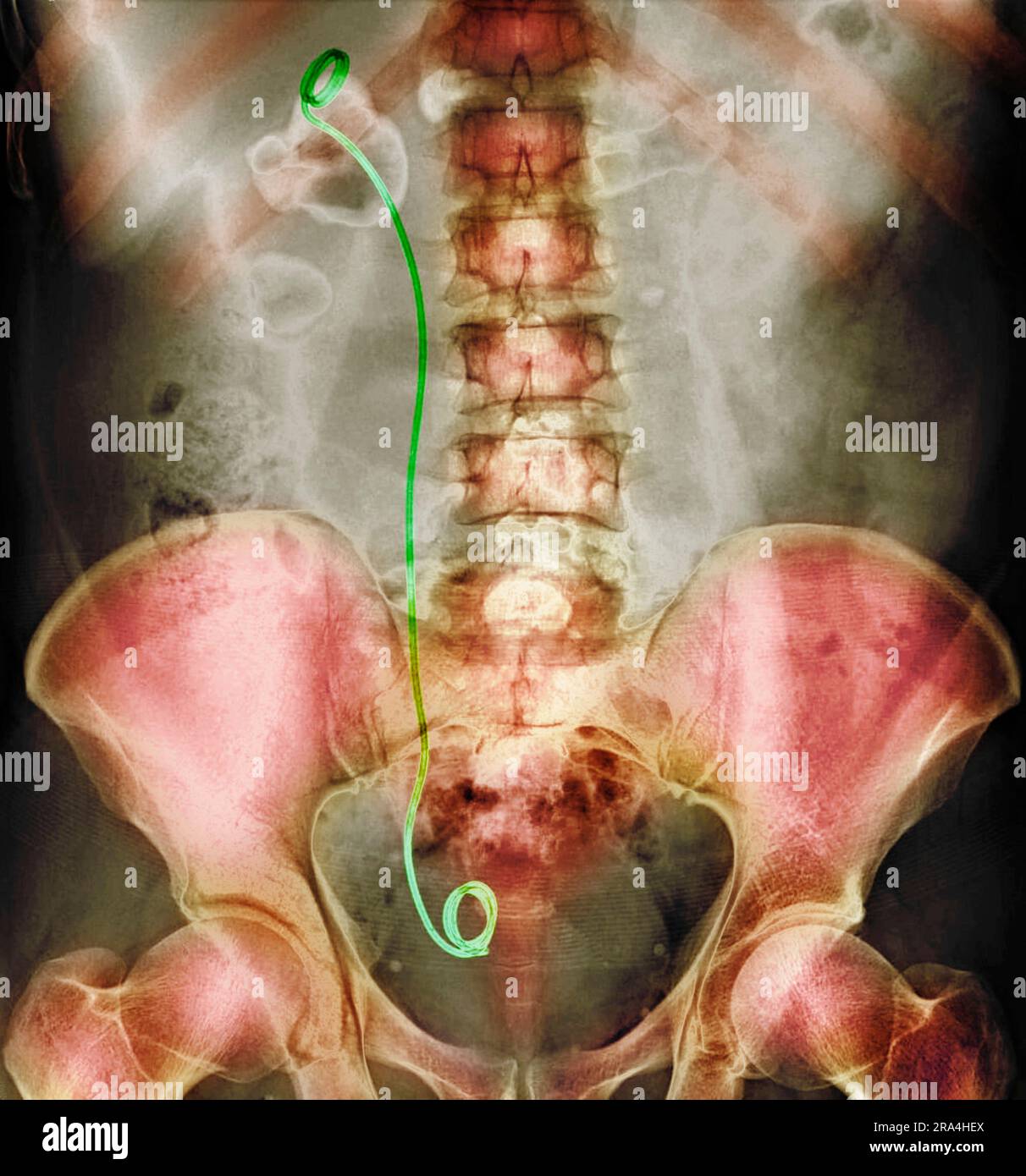Ureter stent hi-res stock photography and images - Alamy