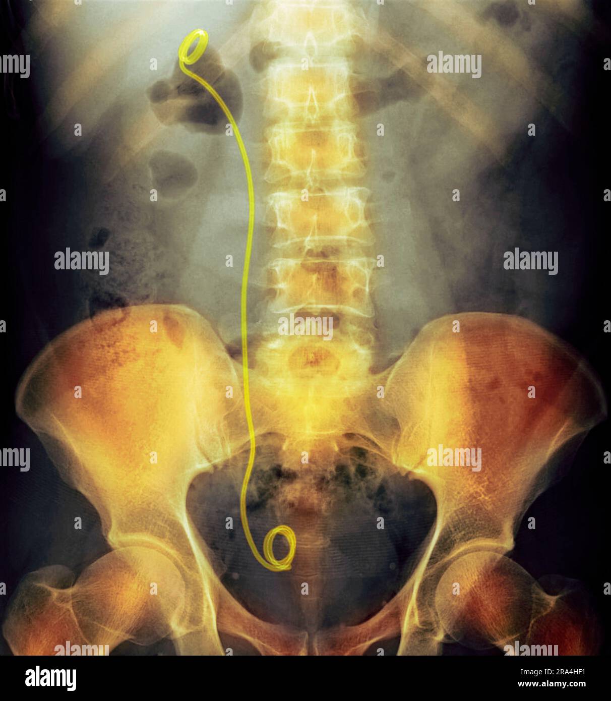 Ureter stent hi-res stock photography and images - Alamy