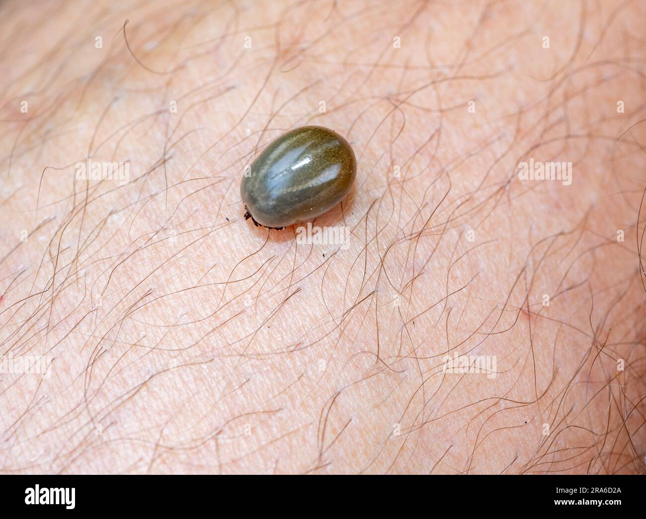 tick soaked with blood on the skin Stock Photo - Alamy