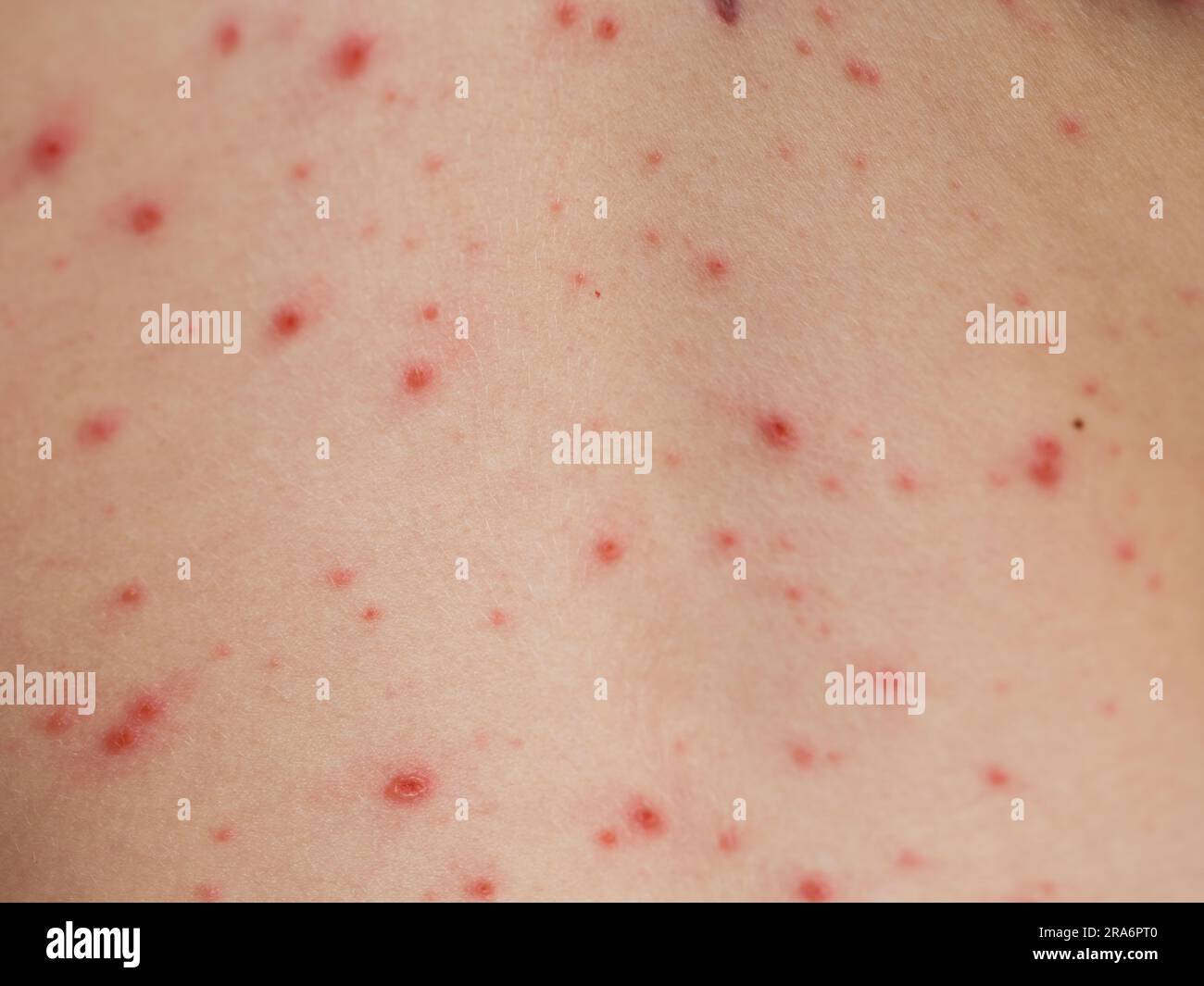 A close up shot of a child body suffers from chickenpox (varicella ...