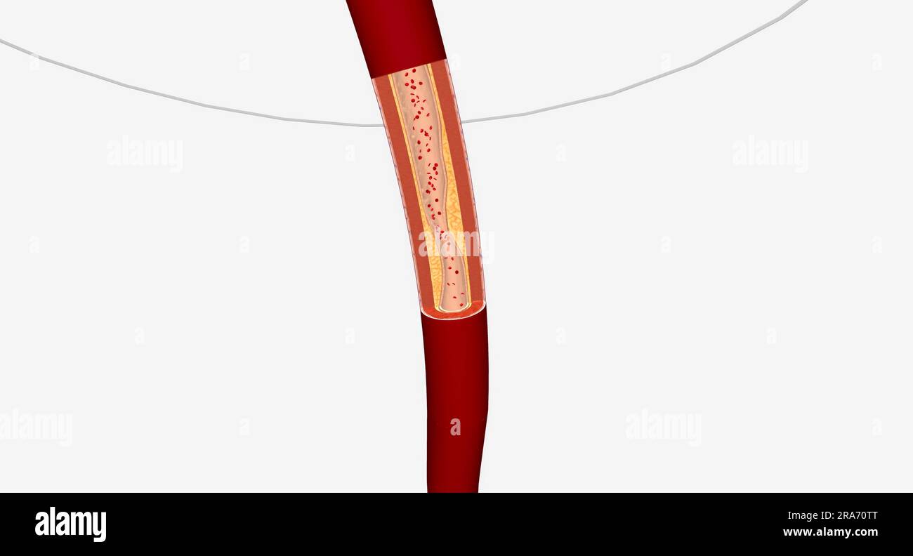 Weakness of the blood vessel hi-res stock photography and images - Alamy