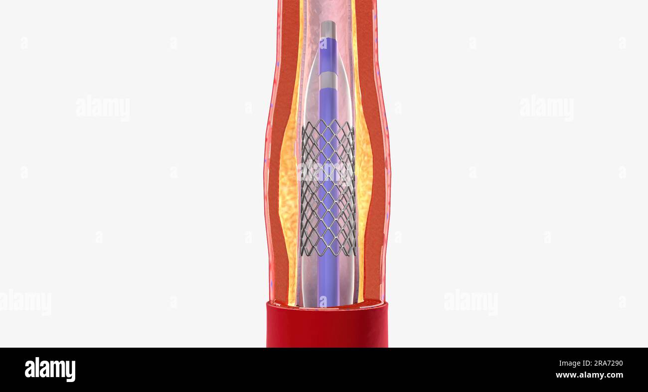 Absorbable stent hi-res stock photography and images - Alamy