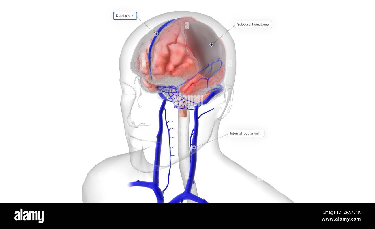 Subdural hematoma dura brain hi-res stock photography and images - Alamy