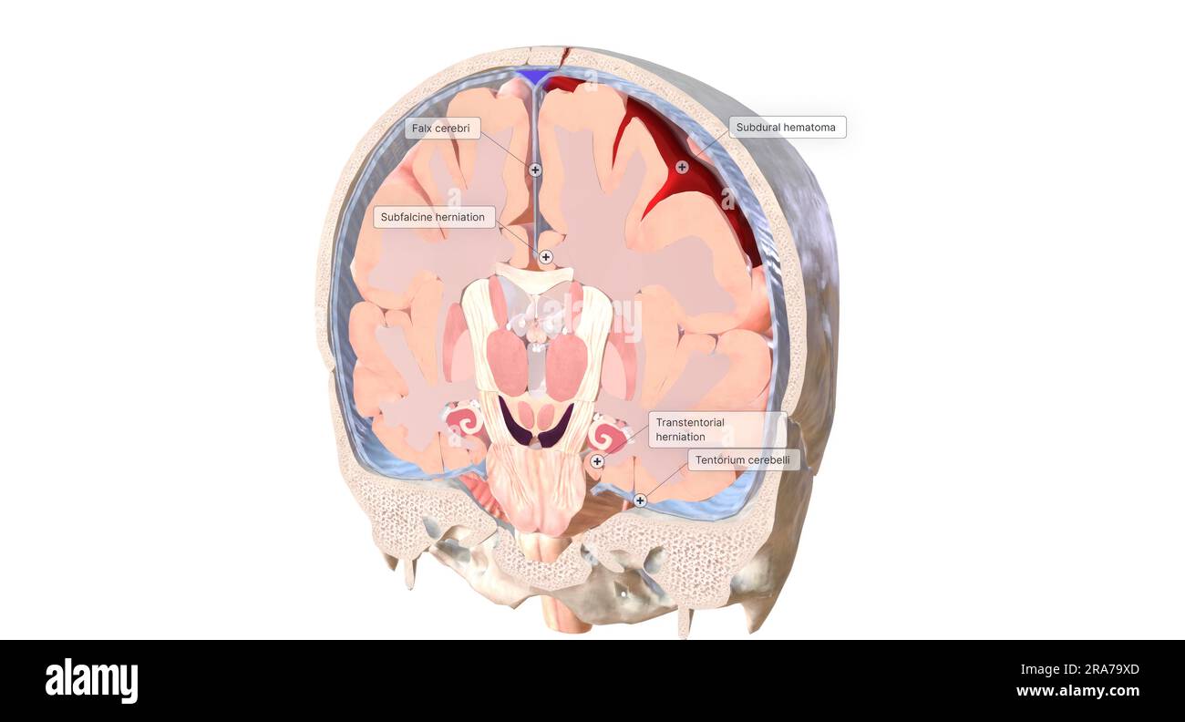 Renal aneurysms hi-res stock photography and images - Alamy
