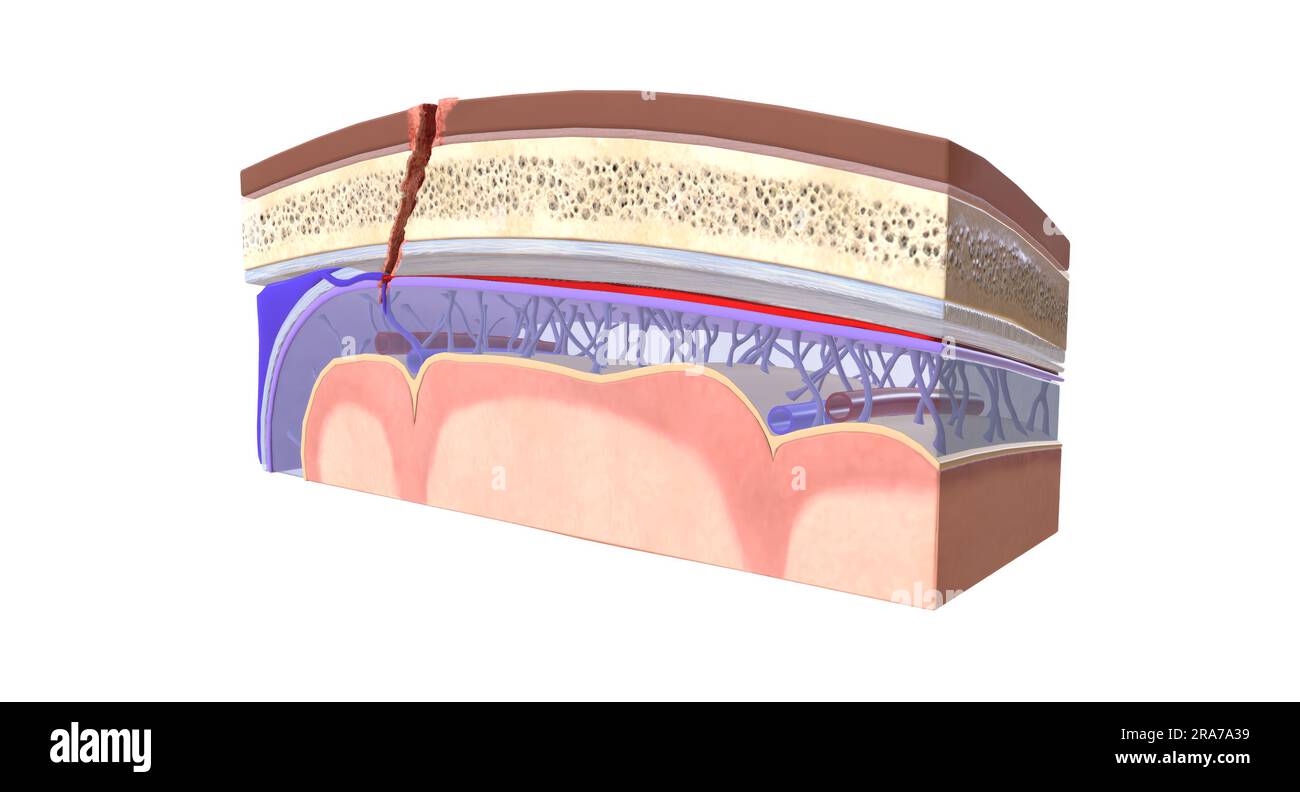 Subdural hematoma dura brain hi-res stock photography and images - Alamy