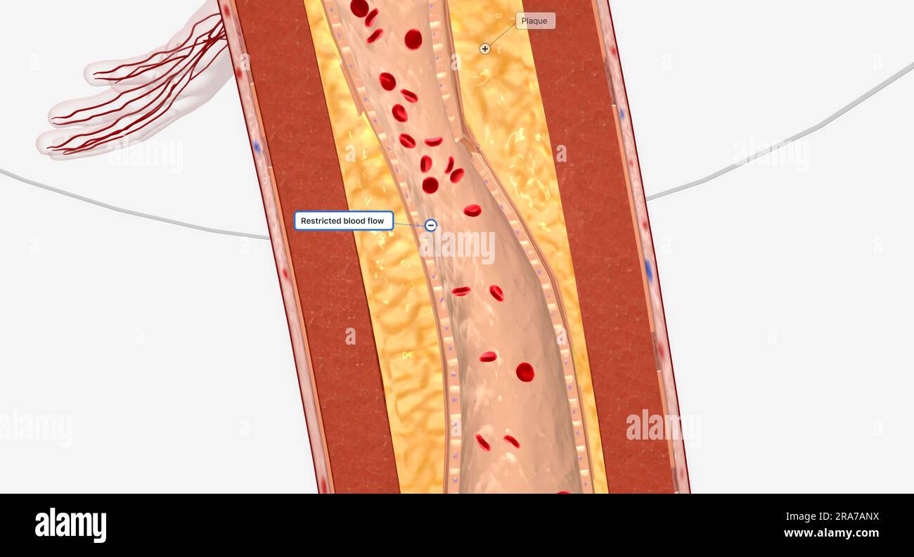 Weakness of the blood vessel hi-res stock photography and images - Alamy