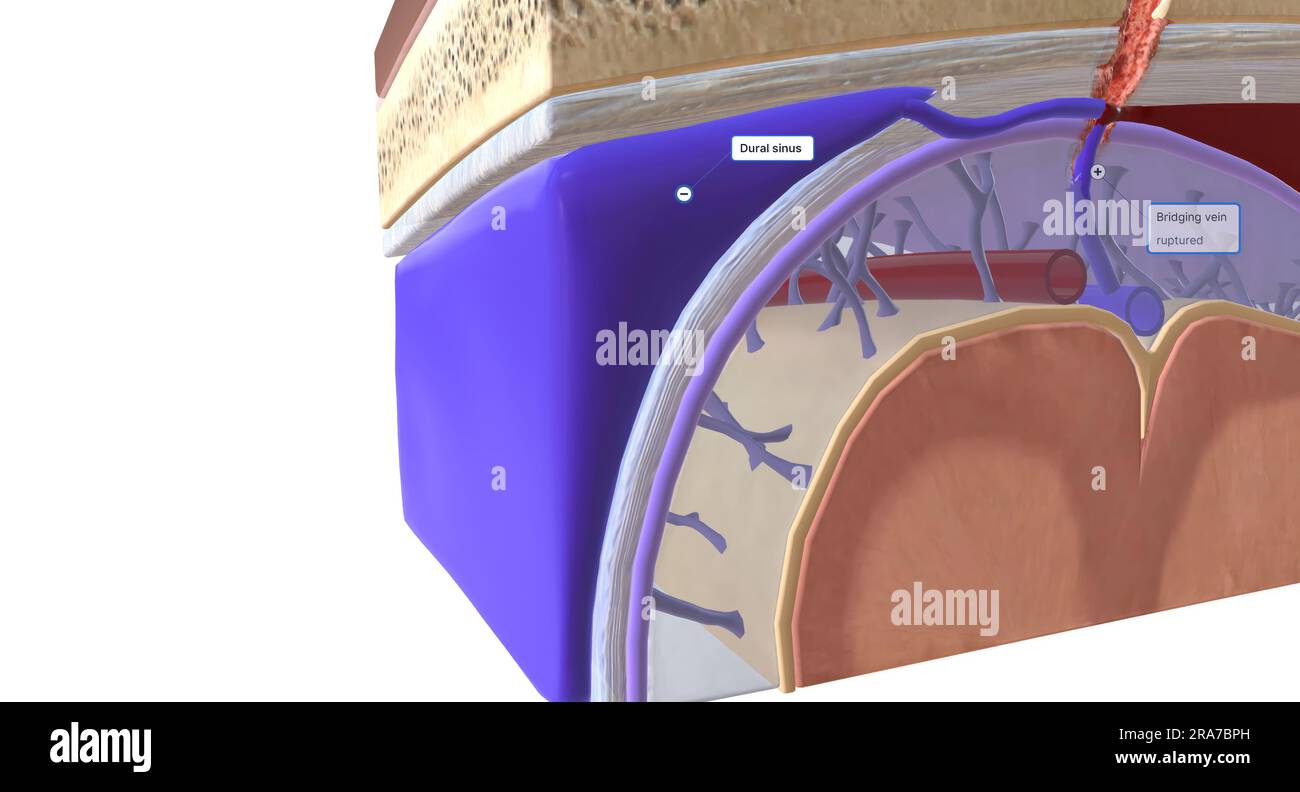 Renal aneurysms hi-res stock photography and images - Alamy